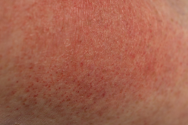 Heat rash, sun rash -- what's the difference? | OSF HealthCare