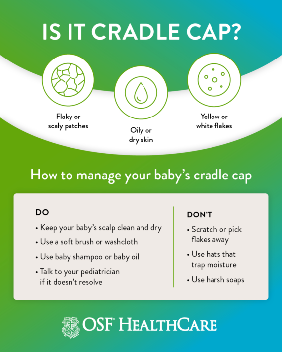 What is cradle cap and how is it treated? | OSF HealthCare | OSF HealthCare